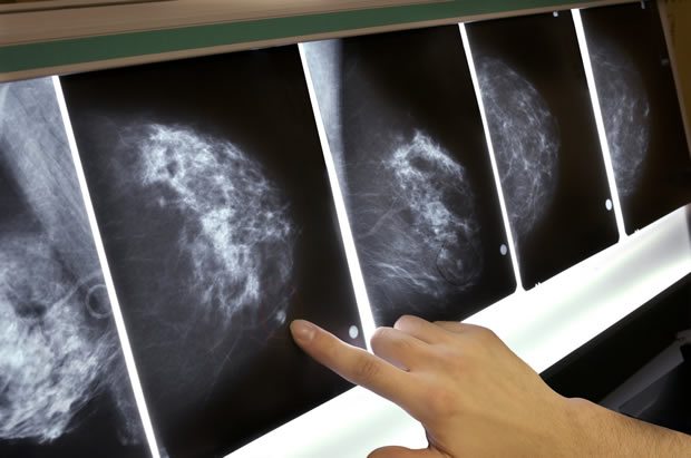 Mammography and overdiagnosis, revisited – Science-Based Medicine